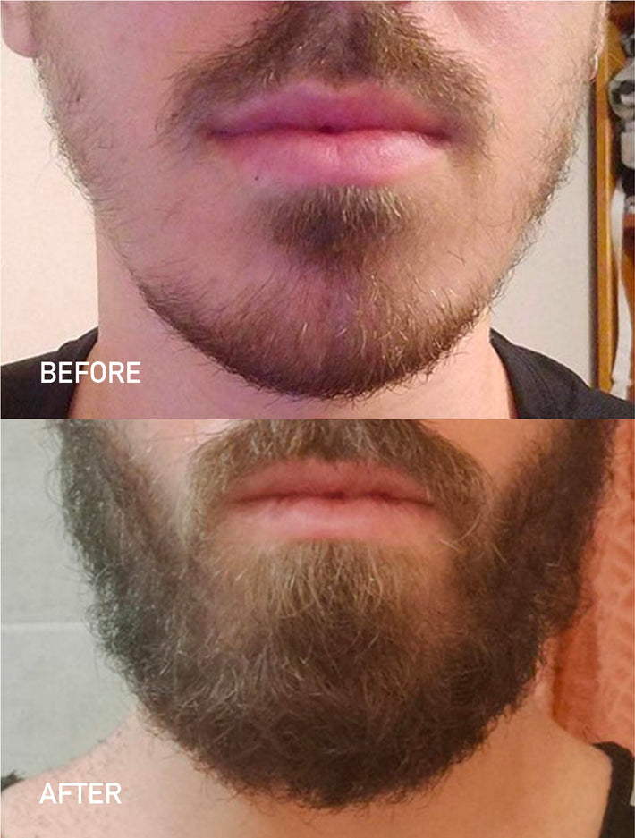 Beard Growth Kit - Beard Roller and Beard Growth Oil – Crafted Beards