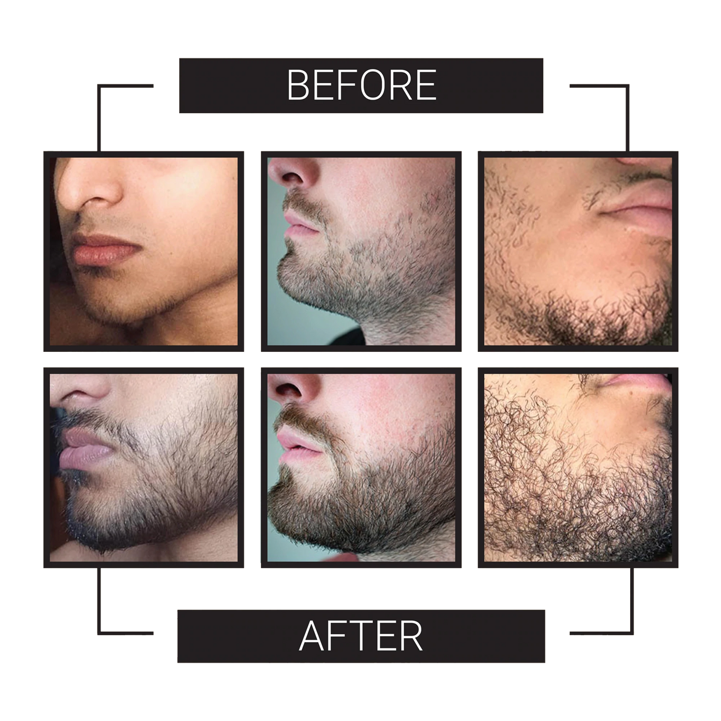 Beard Roller | Micro-Needle Dermaroller for Beard - Free Shipping ...